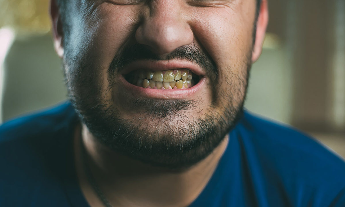 Before And After Meth Teeth